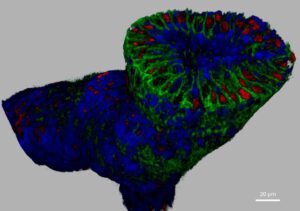 Greater Precision of HER2-Expressing Breast Cancer Treatment with 3D ...